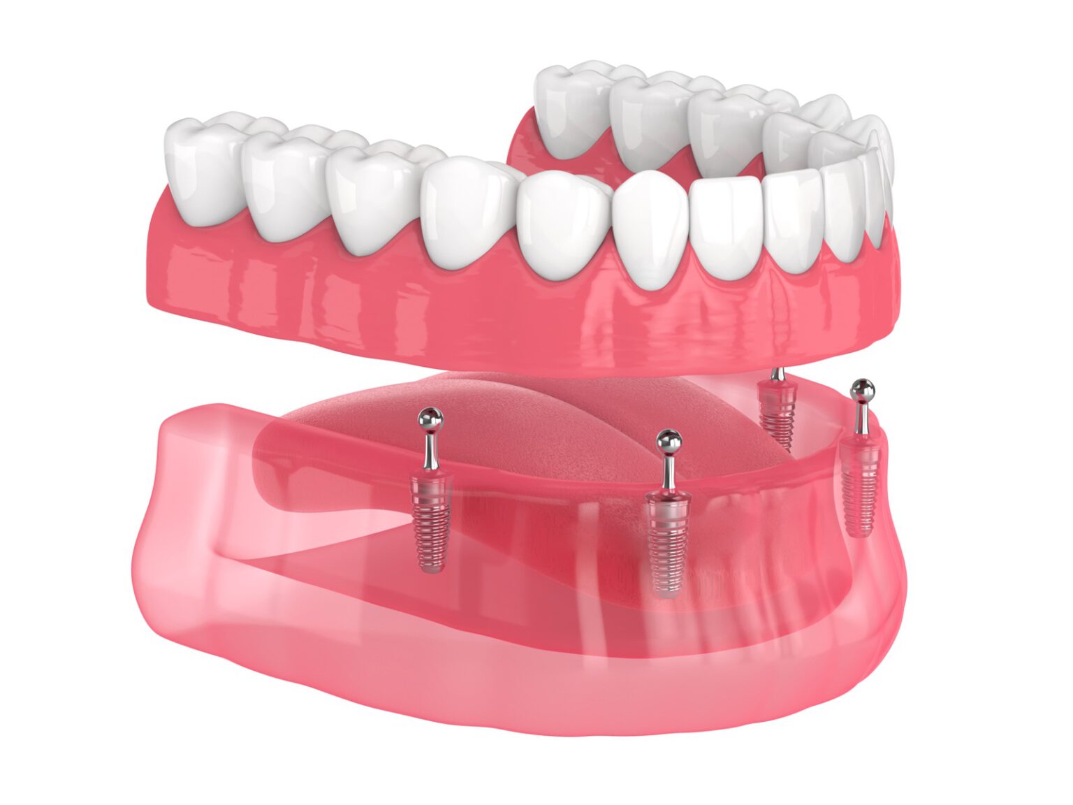 Implant-Retained Dentures in Kitchener, Cambridge & Waterloo | M&I ...